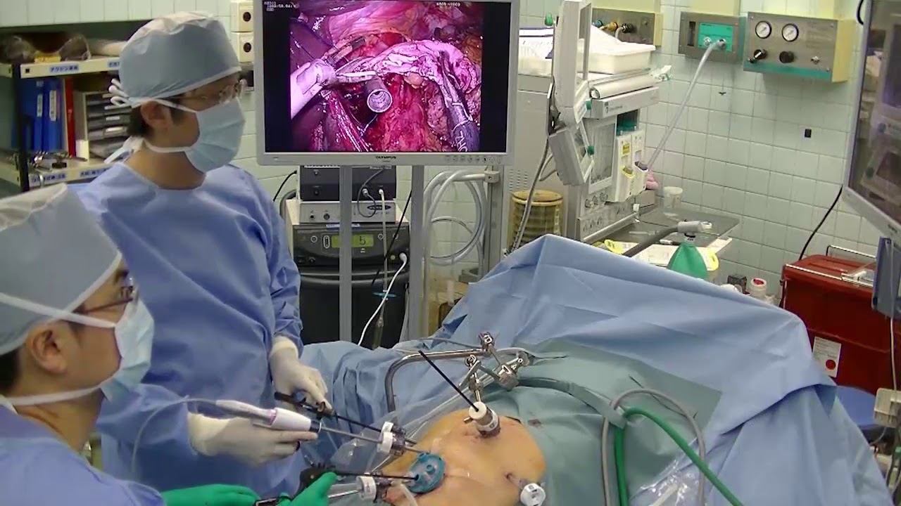 Asvide: Laparoscopic total gastrectomy with D2-No. 10 lymph node ...