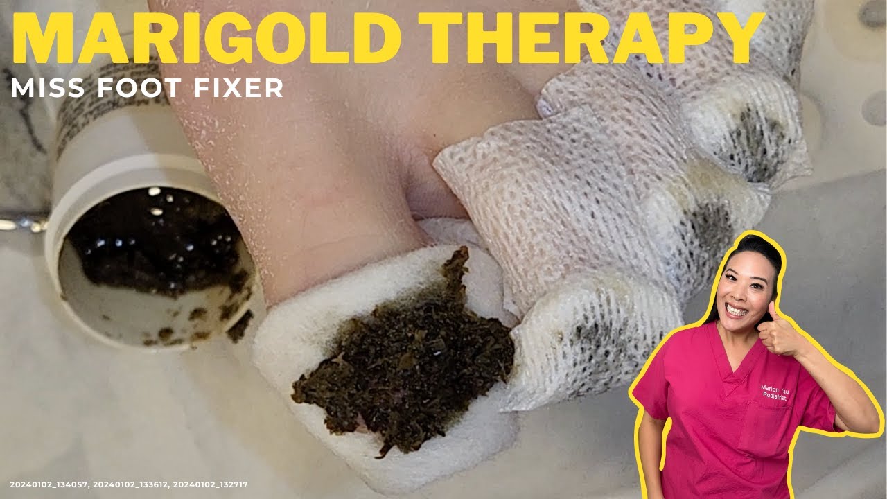 The Healing Power of Marigold Therapy on Foot || Miss Foot Fixer - YouTube