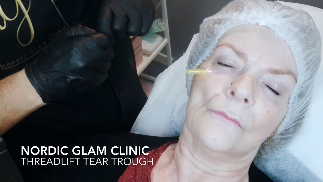 #HOWTO TEAR TROUGH THREAD LIFT WITH PDO - YouTube