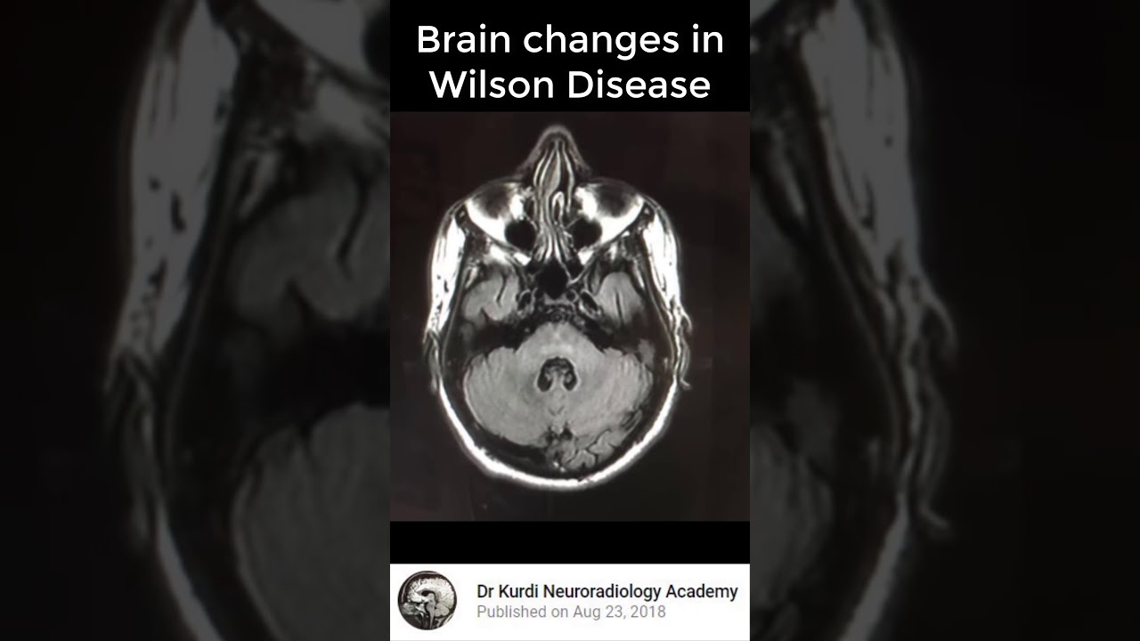 Brain changes in Wilson Disease - YouTube