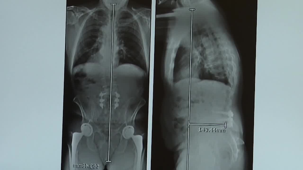 Your Healthy Family: Debilitating back pain - YouTube
