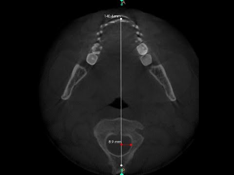 Repetitive head and neck trauma in a 42 year old M - YouTube