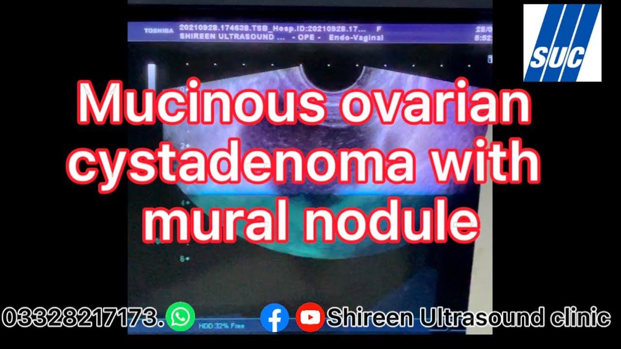 Mucinous ovarian cystadenoma with mural nodule… - YouTube