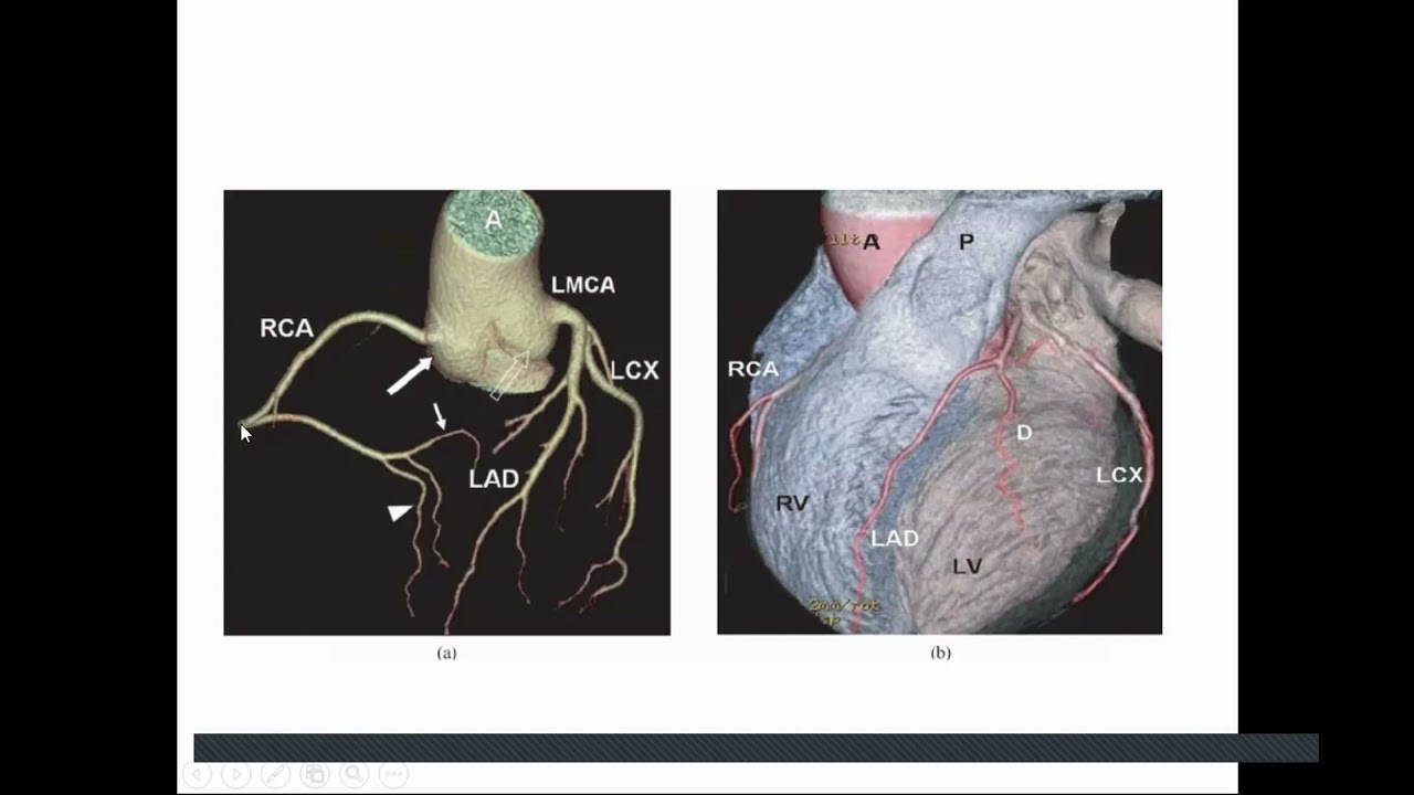 The RAC Sign: Retroaortic Anomalous Coronary Artery - YouTube