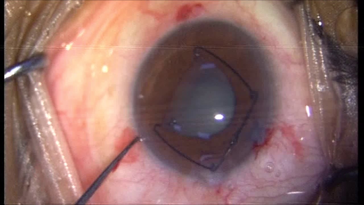 Cataract Surgery in Small Pupil - YouTube