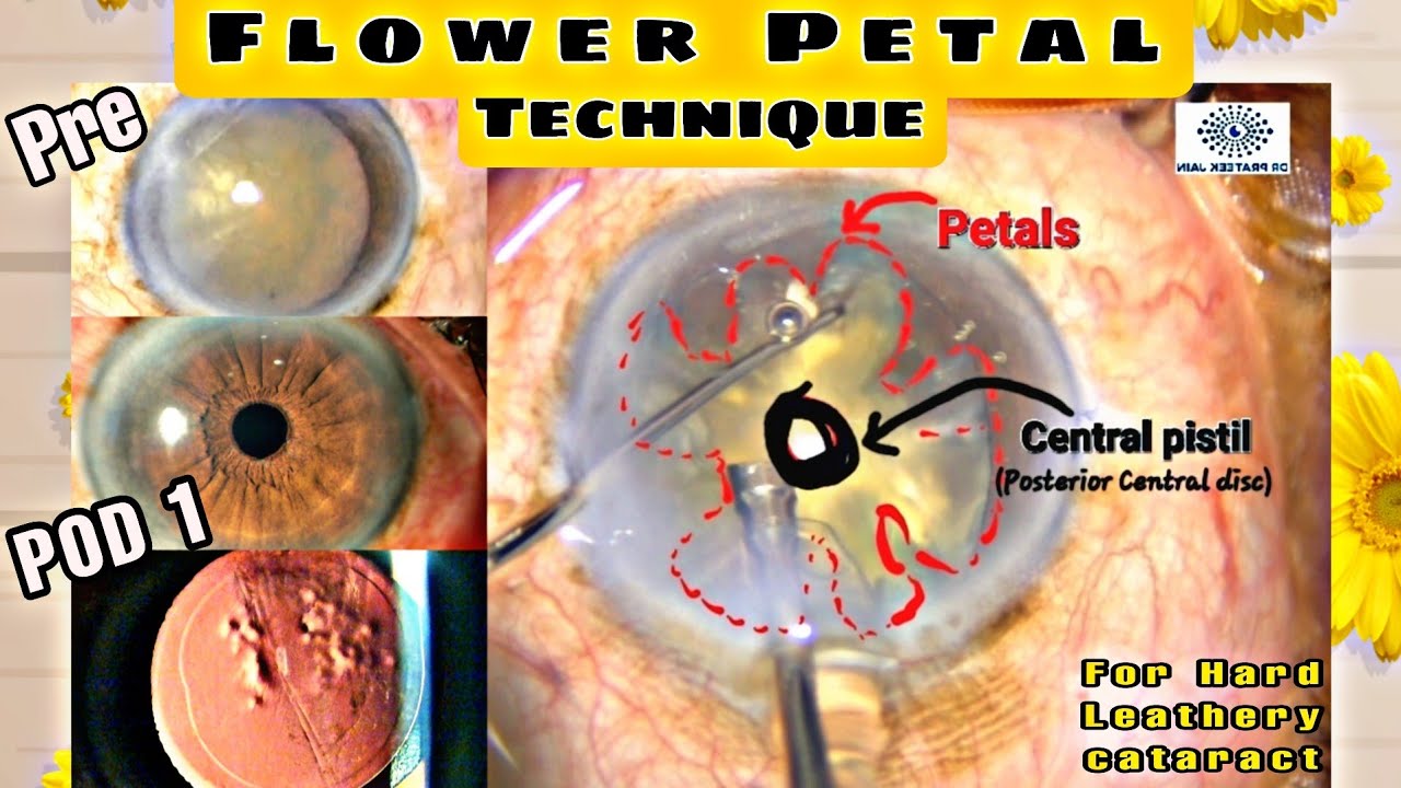 #108 Flower Petal Technique of Phaco in leathery brown cataract |oertli ...