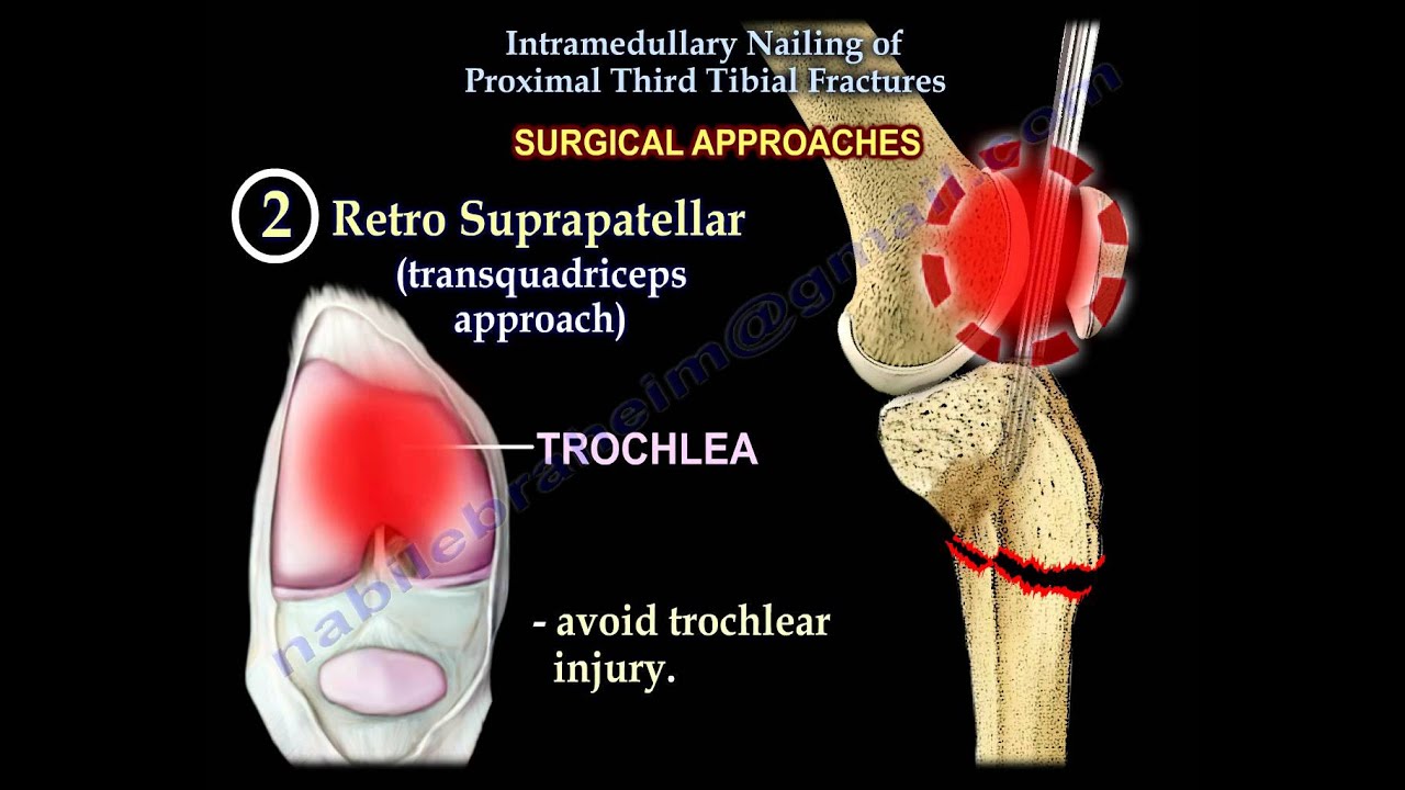 Intramedullary Nailing Proximal Tibial Fractures - Everything You Need ...