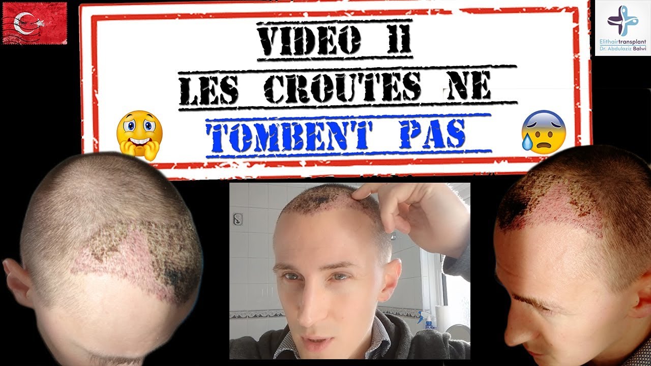 Mes croûtes ne tombent pas - Ma greffe de cheveux FUE [11] - YouTube