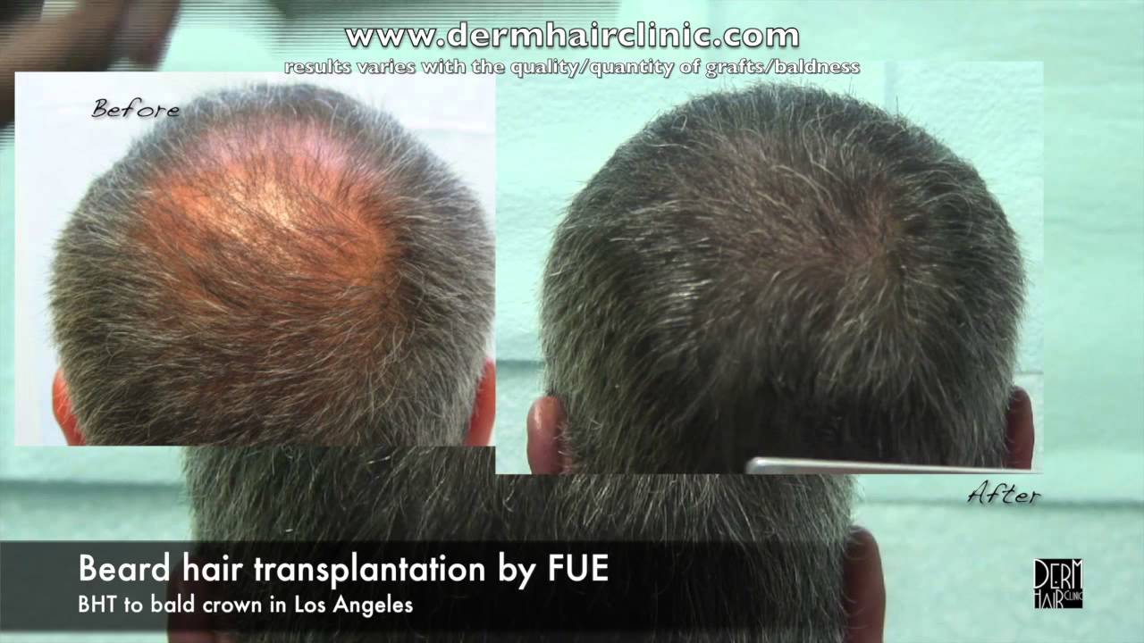 BHT Reverses Crown Hair Loss -- Before and After Video - YouTube
