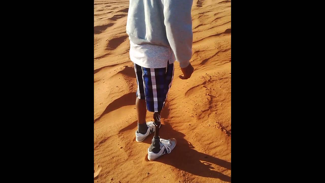 ABOVE KNEE PROSTHESIS - YouTube