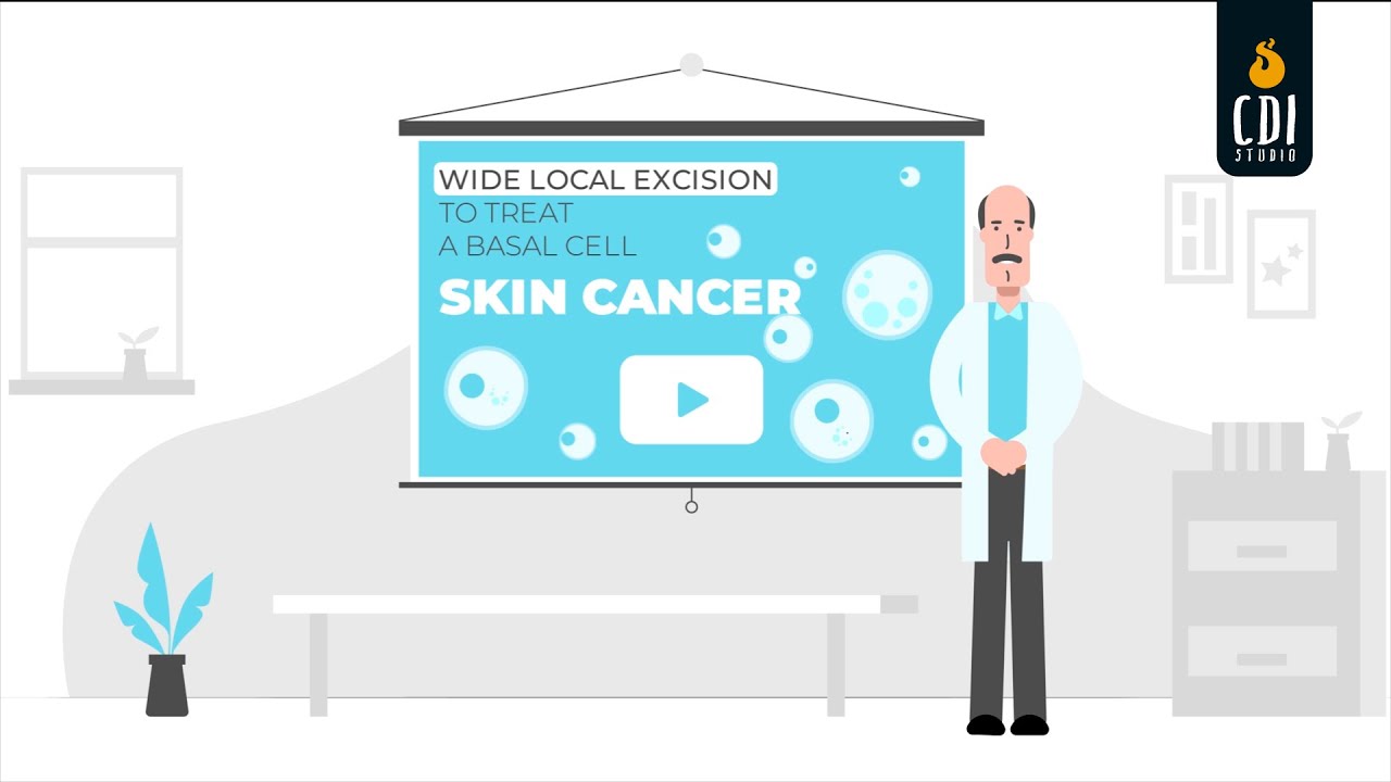 2D Explainer Style Animation of Basal Cell Skin Cancer - YouTube