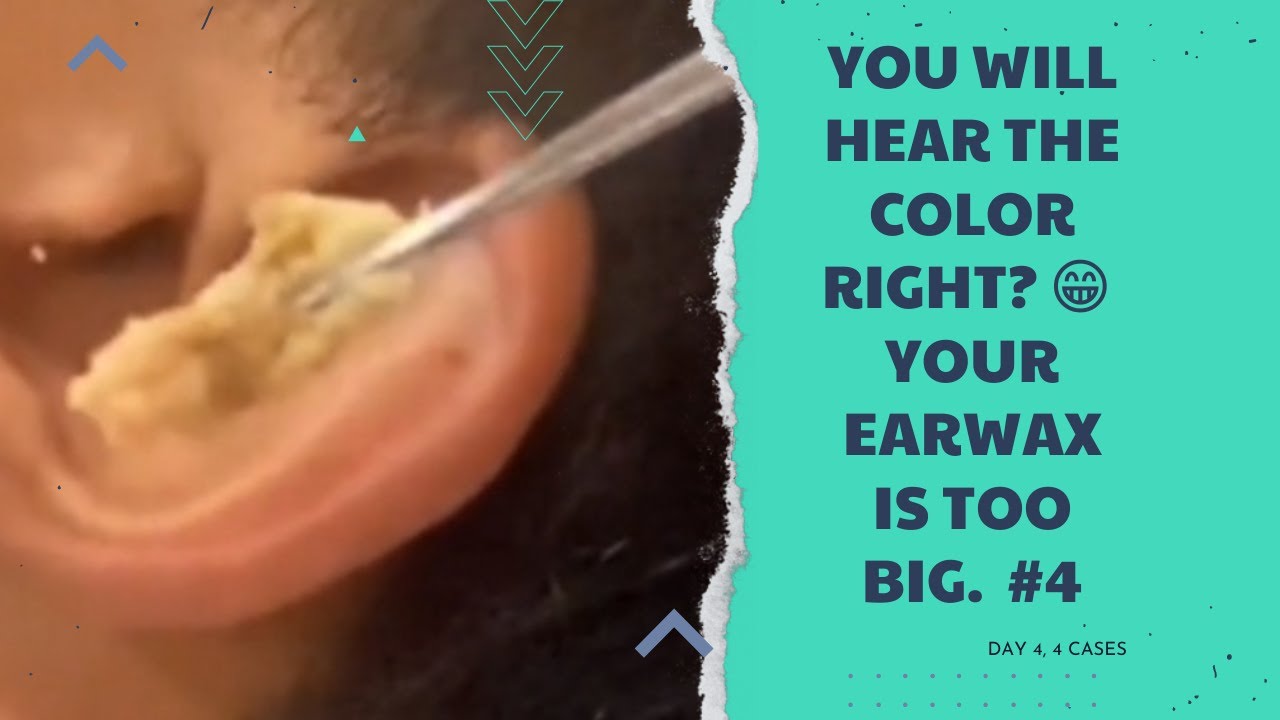 Case #4 Earwax is so big. It seems that it has blocked the ear |Day 4 ...