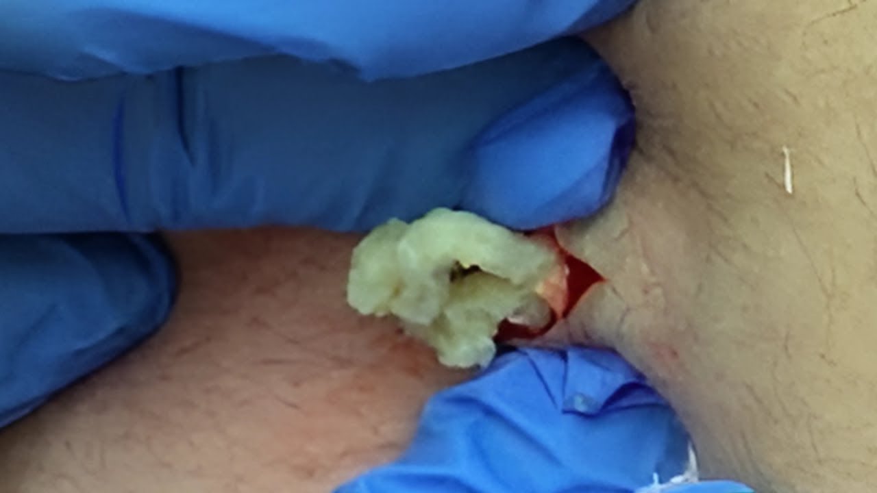 Massive Epidermal Cyst on Lower Back Gets Drained – Pus Explosion ...