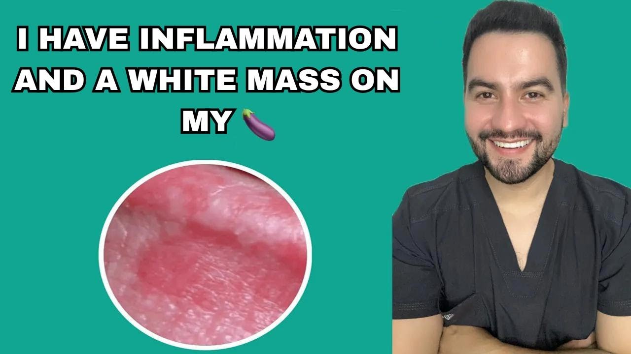 Why is My Foreskin and Penis Head Swollen? | Dr. David Campos Explains ...