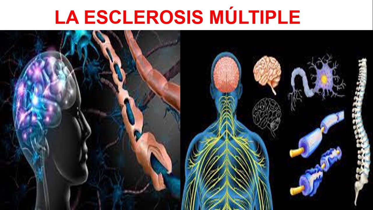 LA ESCLEROSIS MÚLTIPLE - YouTube
