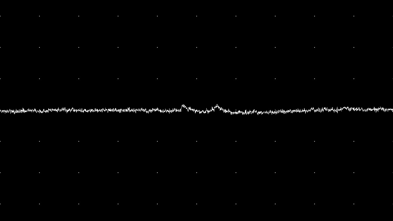 EMG teaching video 2: Abnormal spontaneous activity: fibrillation potential - YouTube