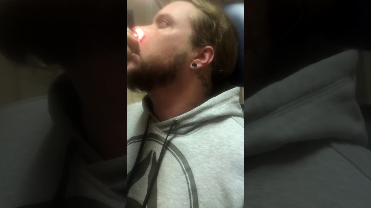 Septoplasty splint removal and packing removal! 2020 - YouTube