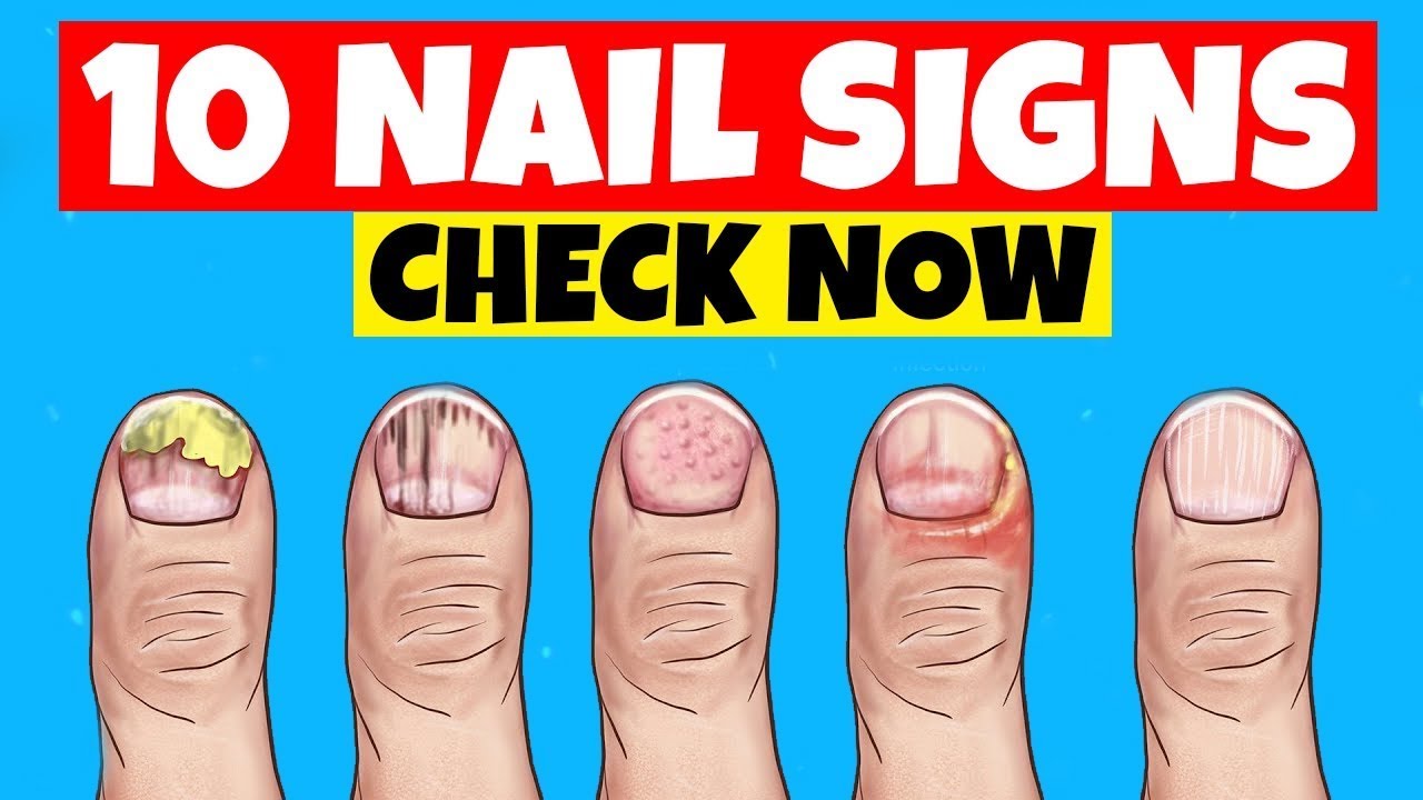 10 Nail Signs Which Tell You a Lot About Your Health Check NOW - YouTube