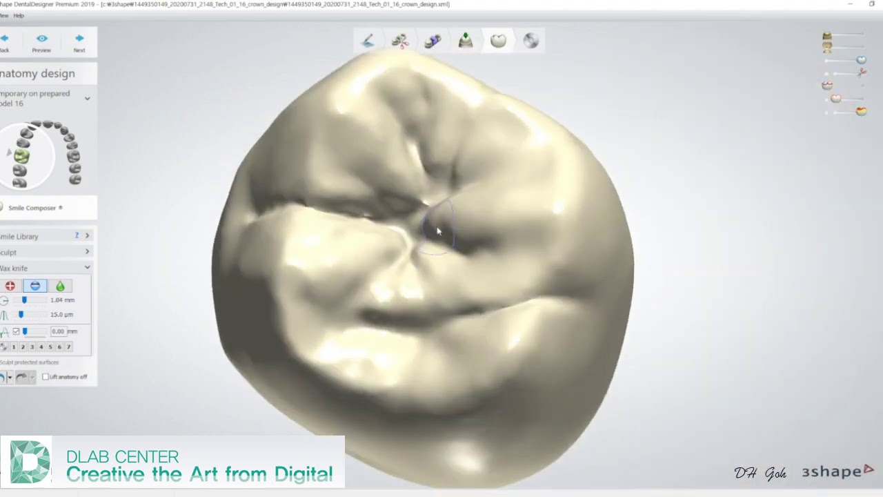 upper first molar design by 3shape - YouTube
