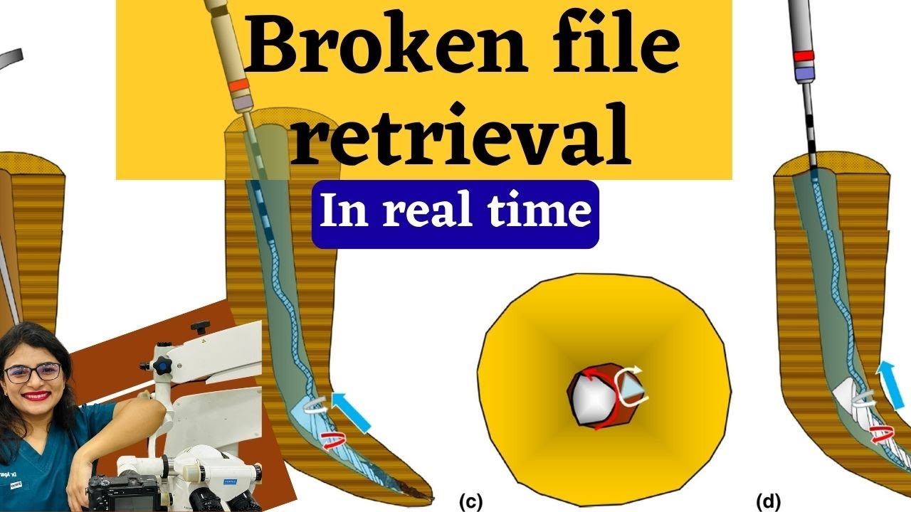 Endodontic Rescue! Real-Time Broken Rotary File Retrieval|Dr Aparna ...