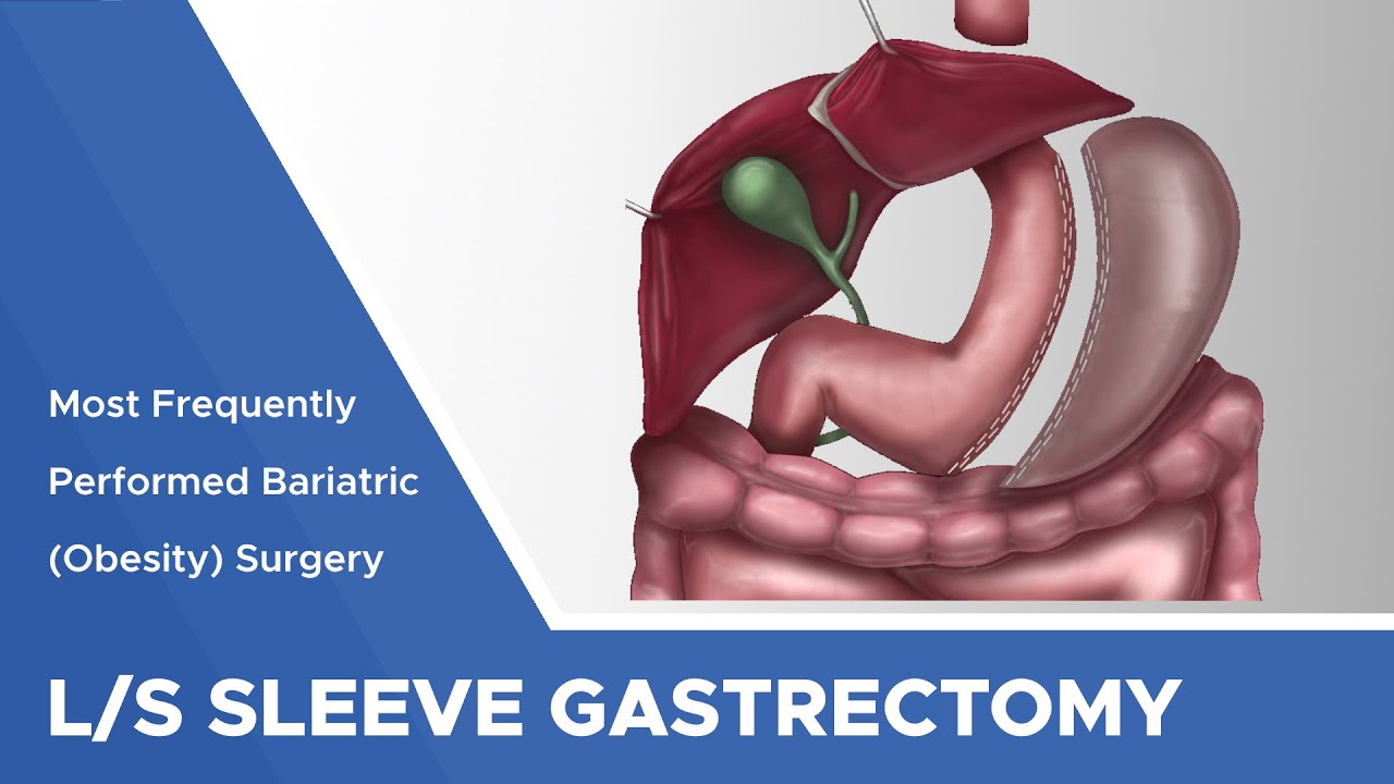 Most Frequently Performed Bariatric (Obesity) Surgery: Laparoscopic ...