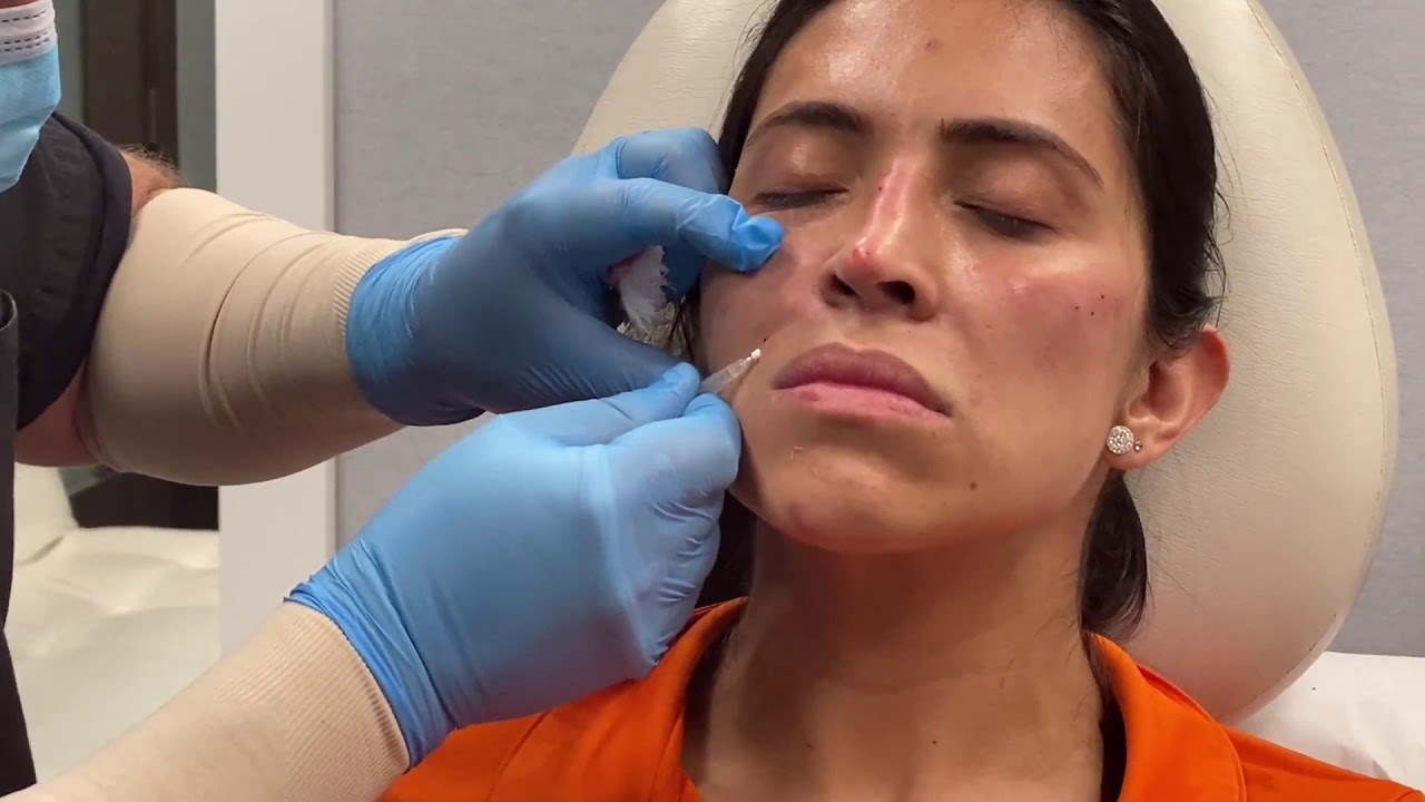 Cheek and Nose Filler with Twist Threads in New Jersey - YouTube
