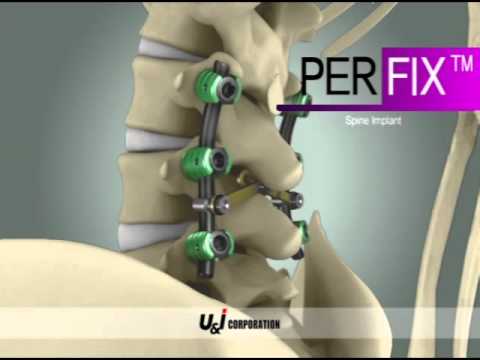 Sistema Perfix - YouTube
