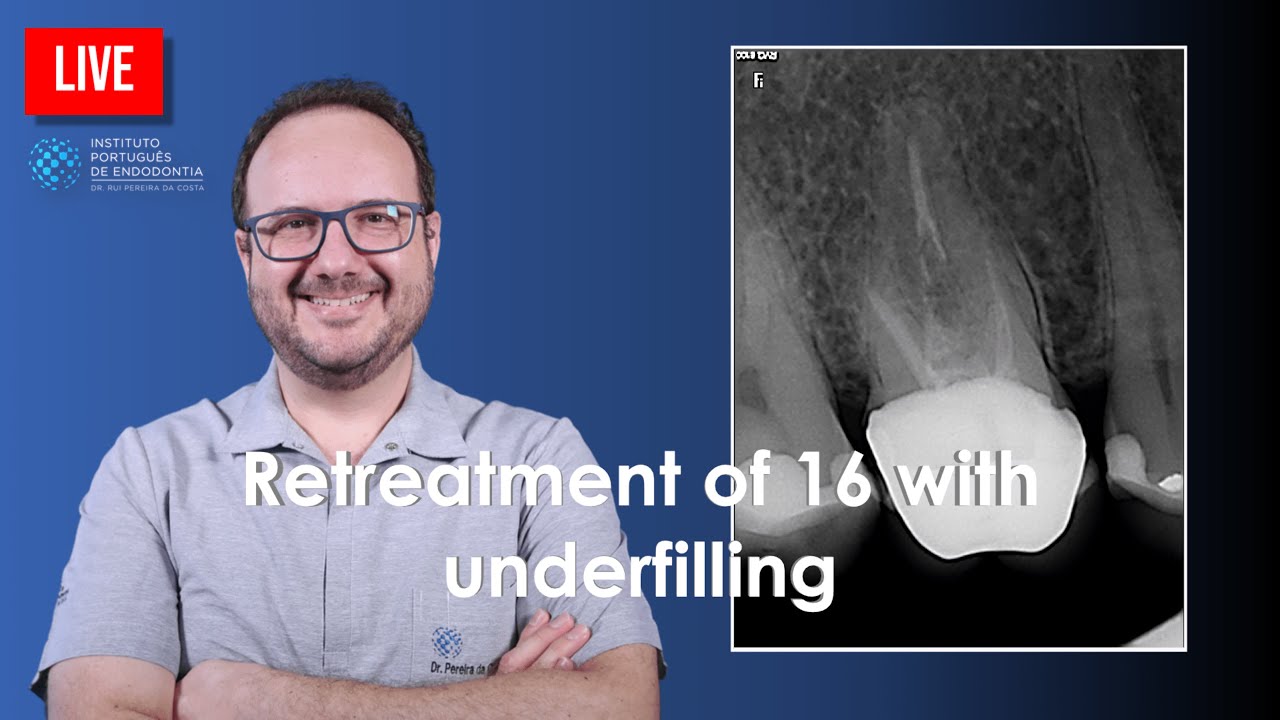 🔴Retreatment of 16 with underfilling and fiber post - YouTube