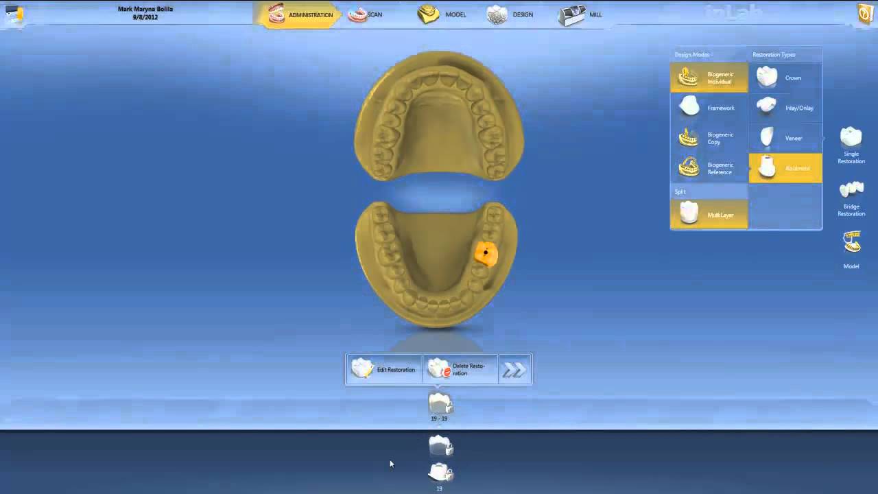 #19 MIS implant, Inlab by Cerec - YouTube
