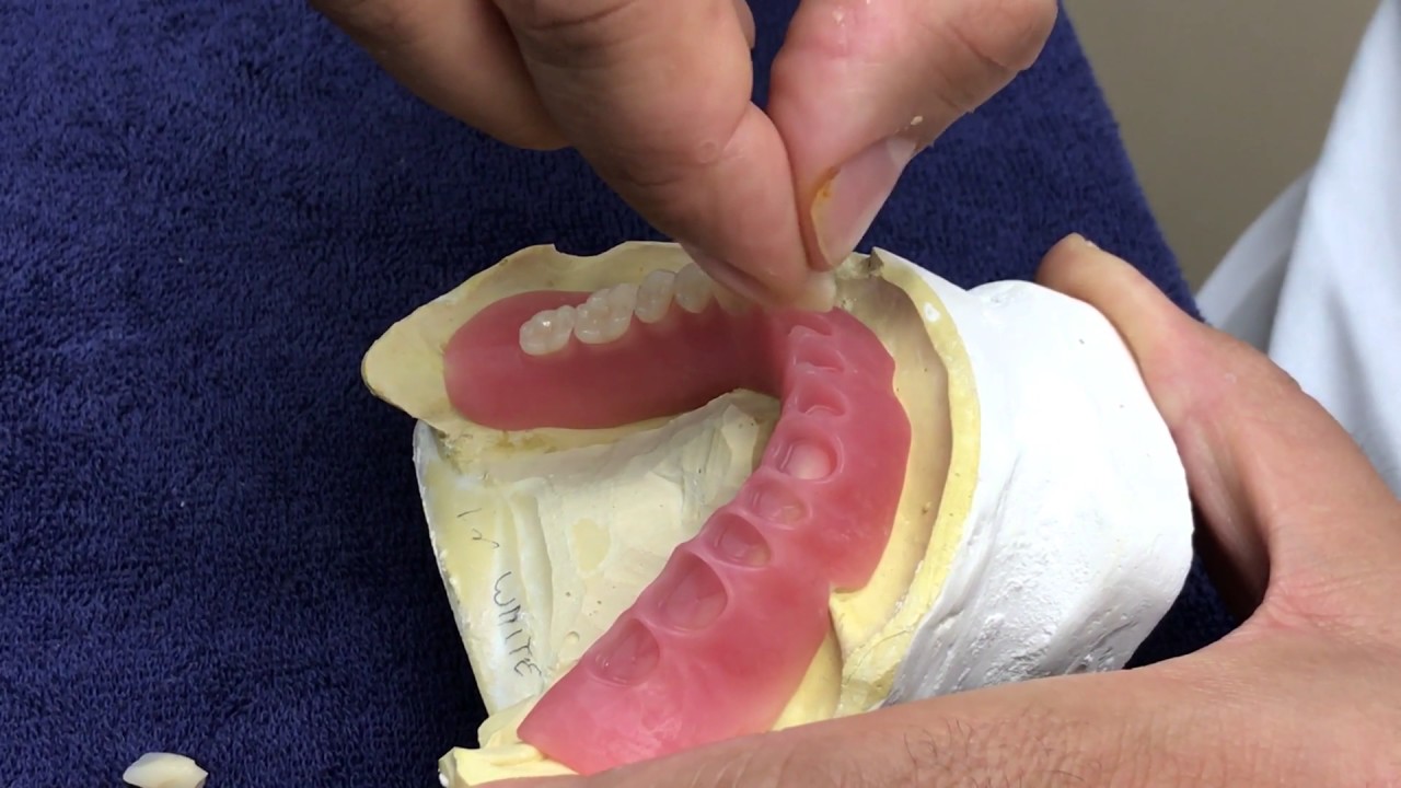 Assembly of Denture Teeth in Denture Digitally Designed using PDC - YouTube