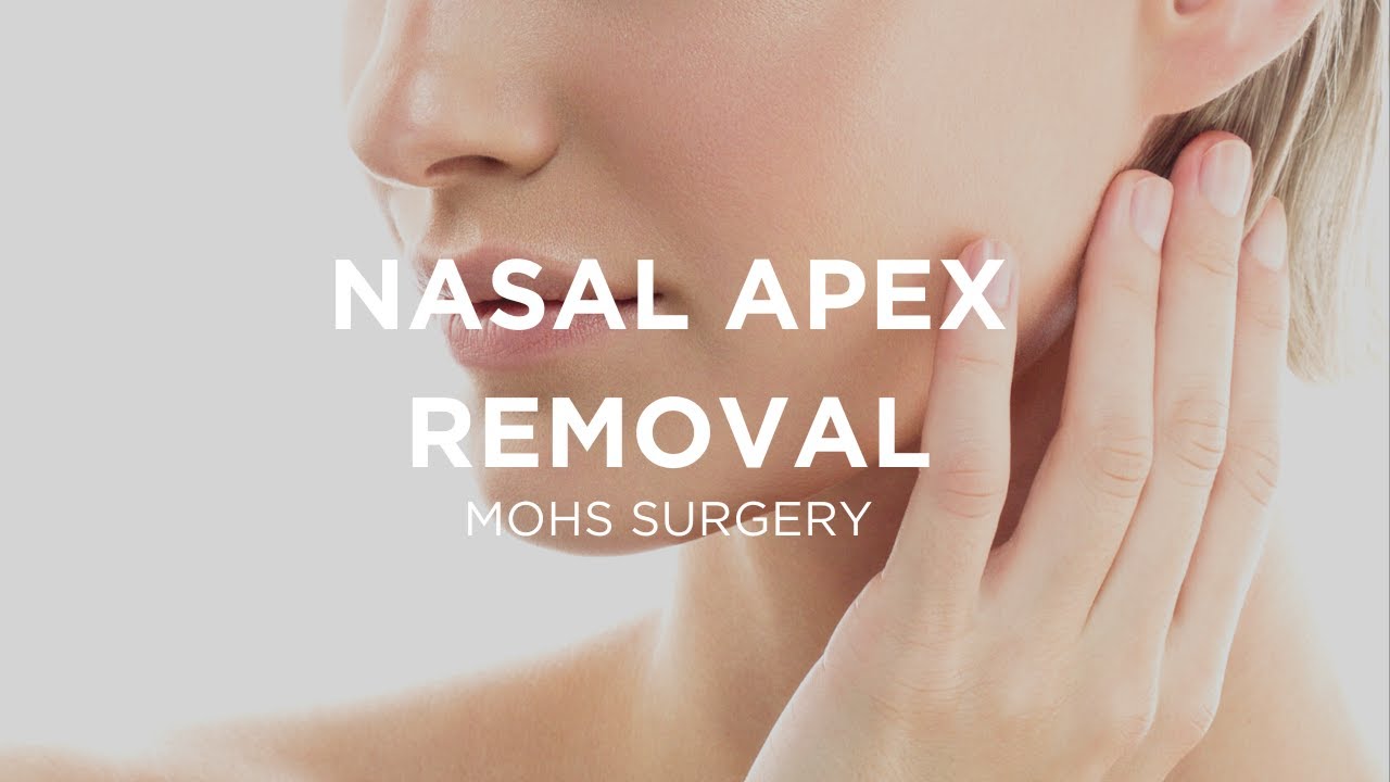 Nasal Apex Removal | Mohs Surgery Skin Care - YouTube
