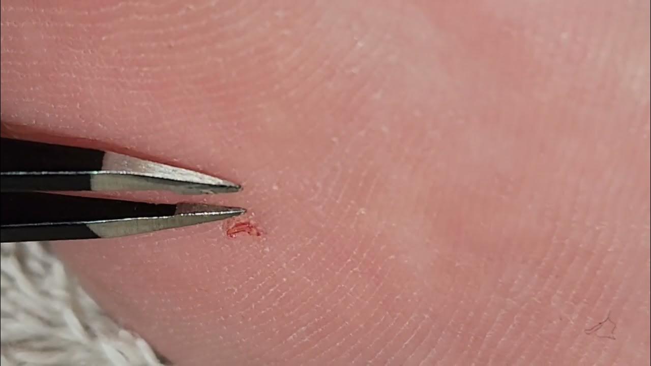 Glass In Foot Youtube
