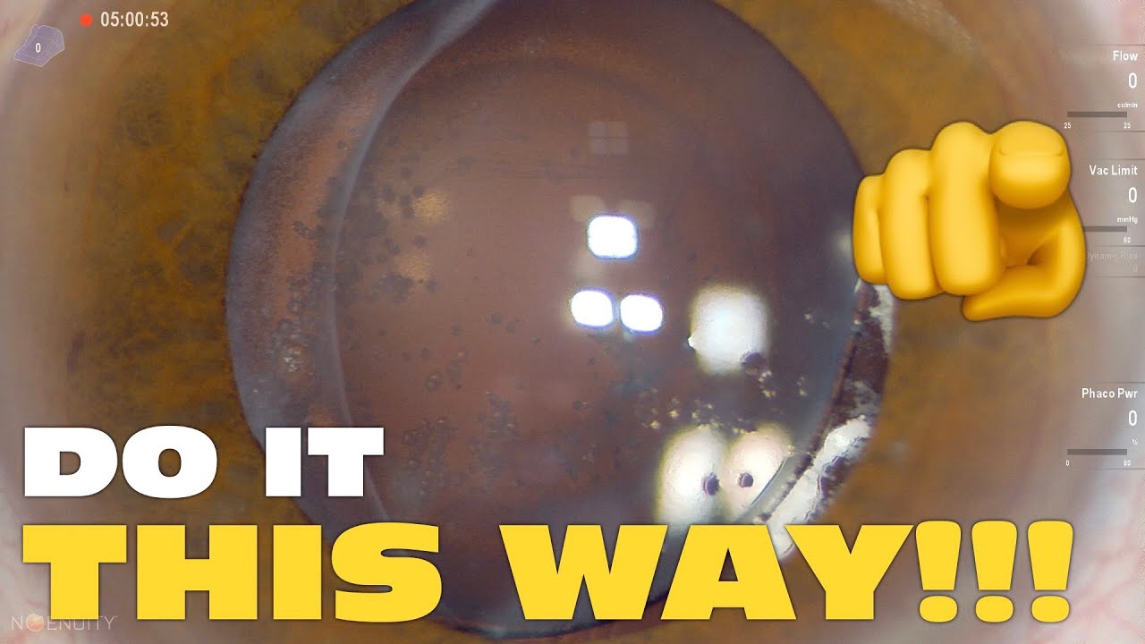 SICS CLIP #7 - Smooth IOL Exchange Through SICS Tunnel - YouTube