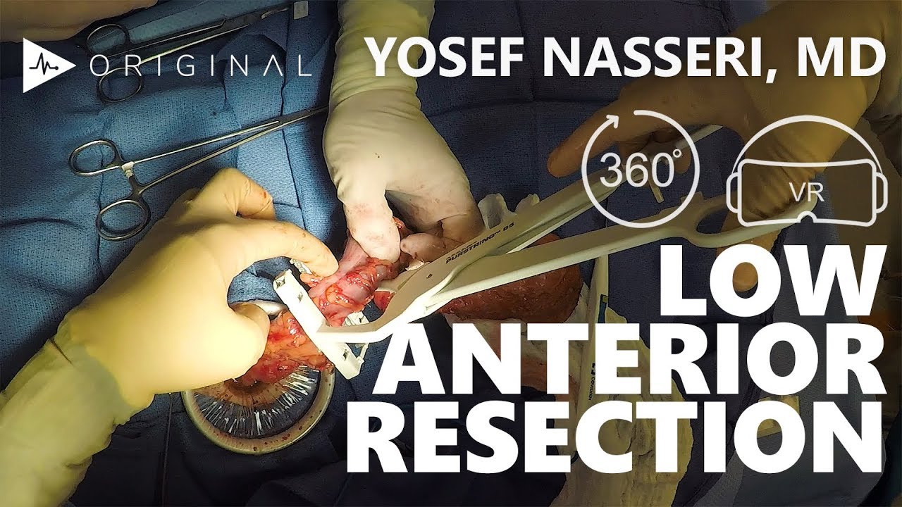 Low Anterior Resection