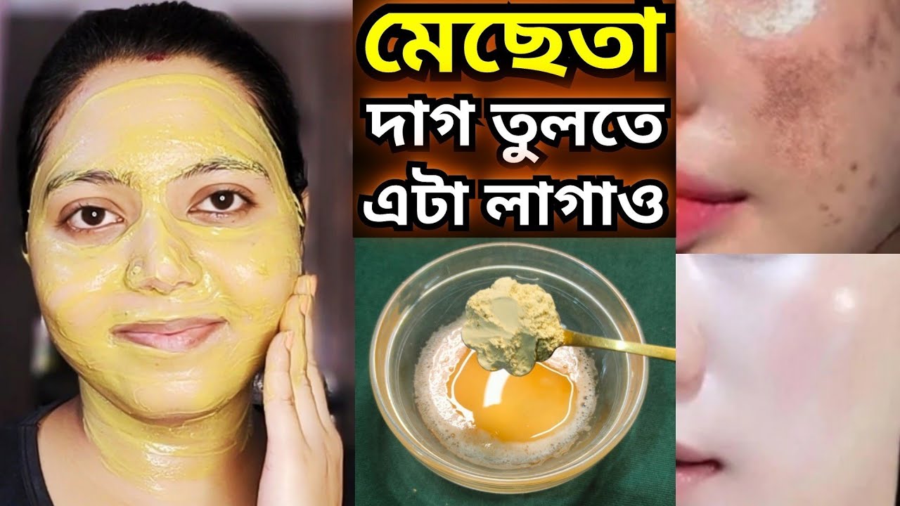 রাতারাতি মেছেতার দাগ তুলতে এটা আজই লাগাও/ মুখের কালো দাগ তোলার উপায় ...