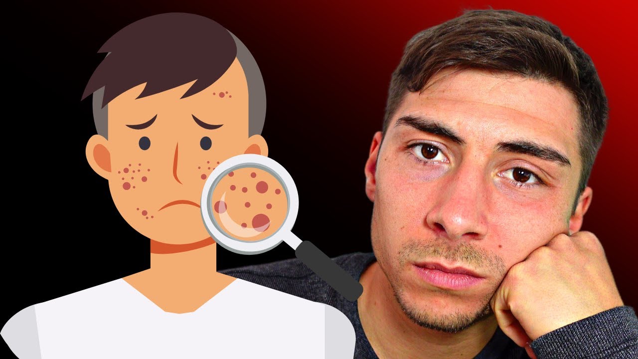 Nie wieder Pickel - YouTube