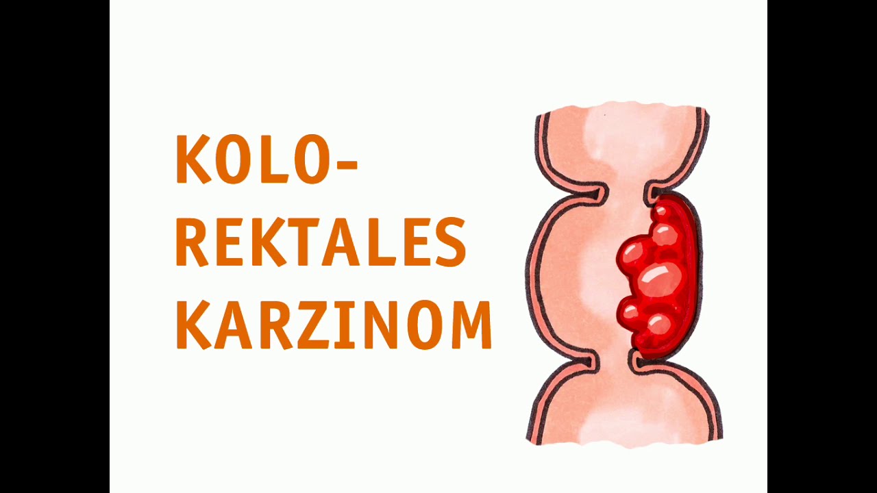 Das Colorectal-Karzinom: Ausschnitt aus der Lernplattform der arche ...