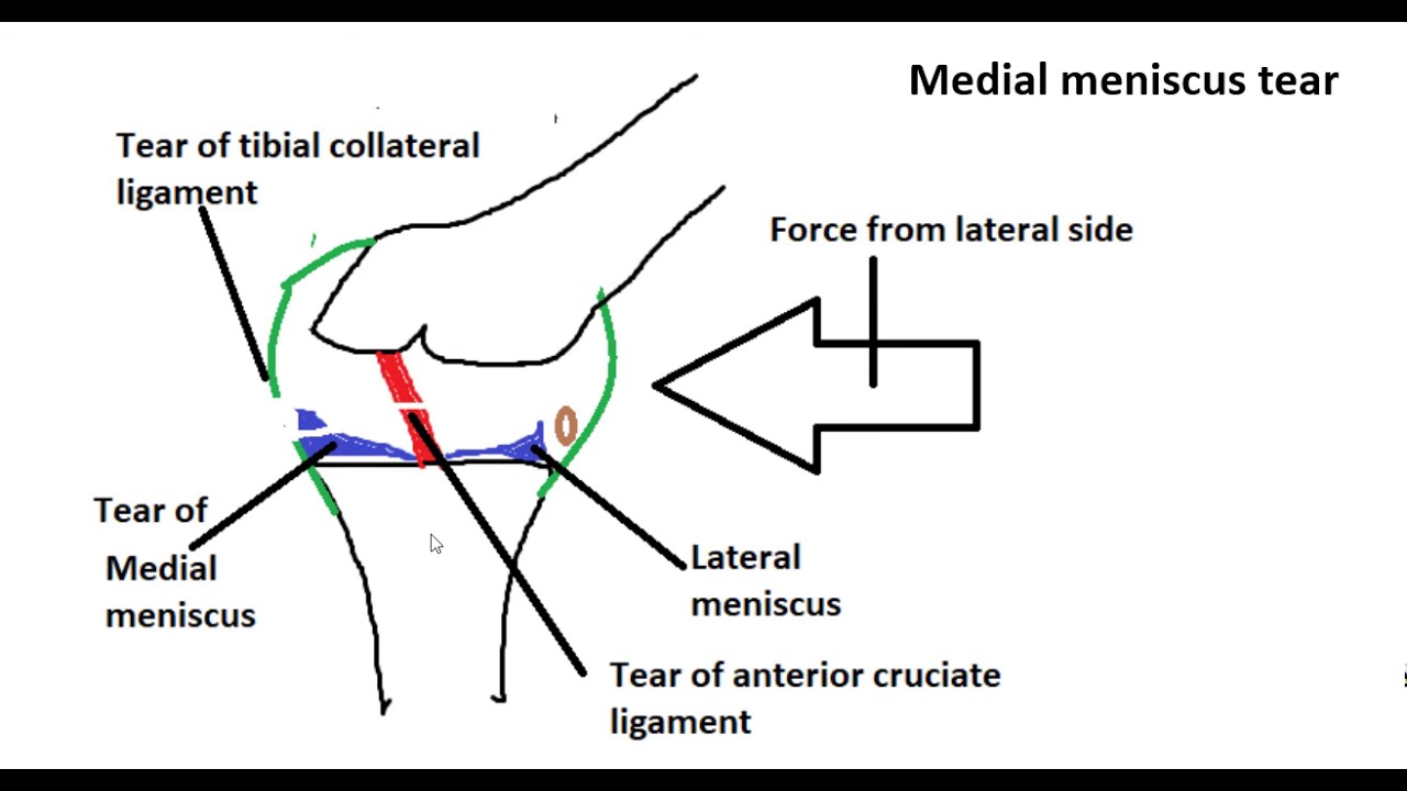 Inside the Knee Joint: Decoding the Differences Between Medial and ...