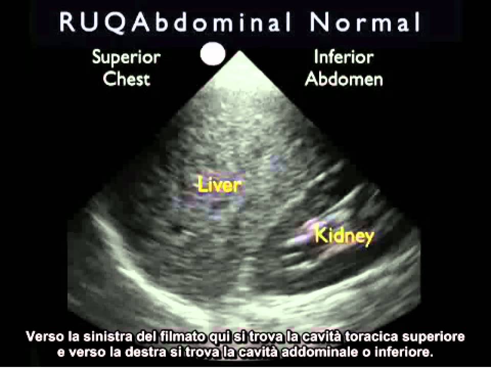 Video procedurale: Esame RUQ FAST - Esame normale - YouTube