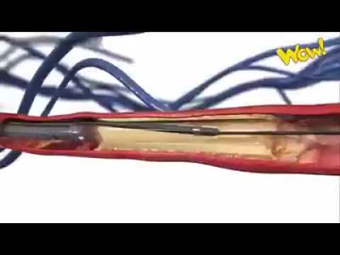 Cholesterol Remove Surgery - YouTube