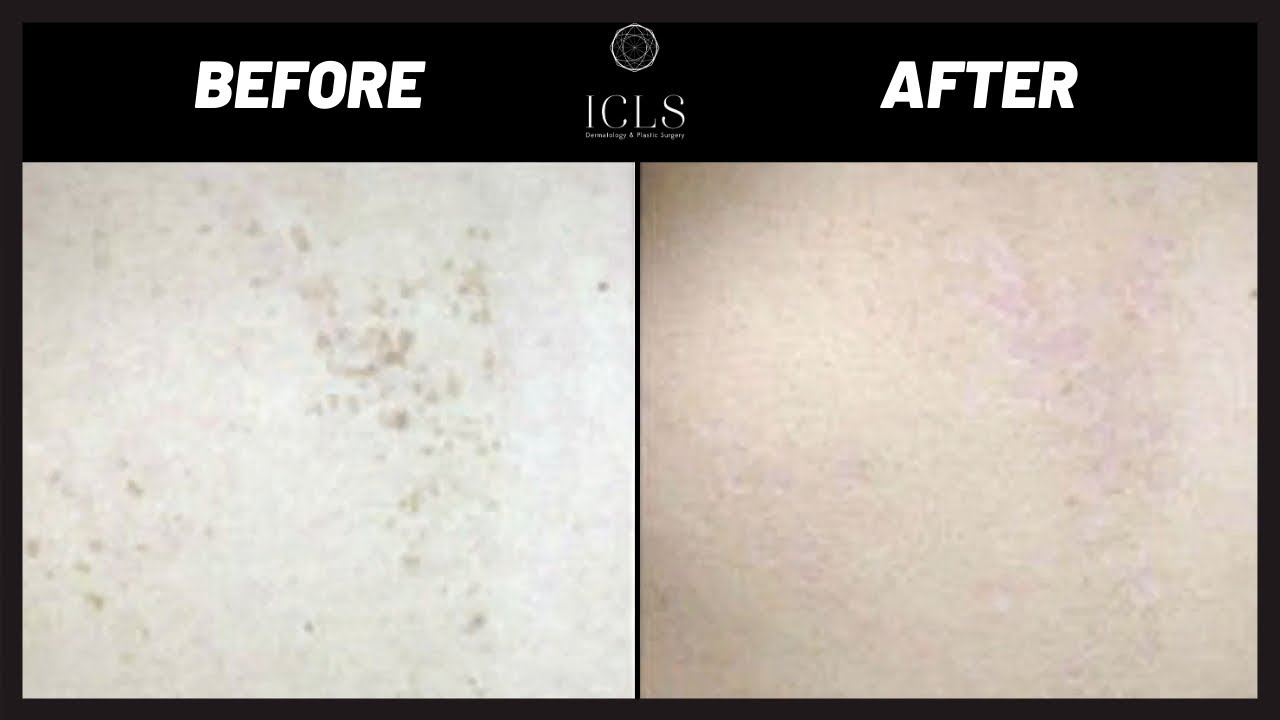 Epidermal Nevus Removal | Surgical & Non-Surgical | ICLS Dermatology ...