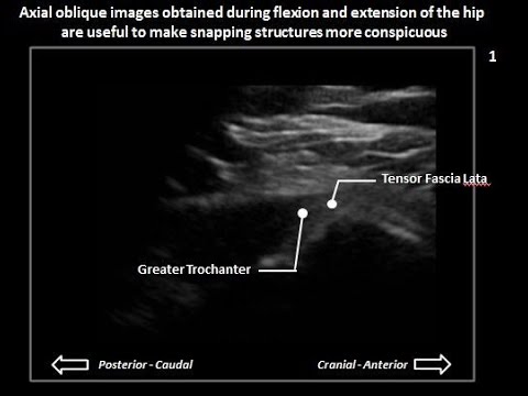Lateral snapping hip syndrome (coxa saltans) on dynamic hip ultrasound ...