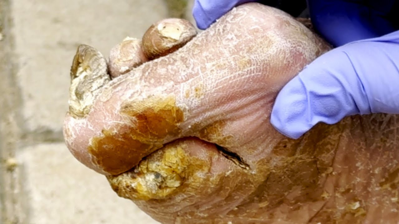 How To Trim Twisted Toenails And Restore Them To Health Step By Step ...