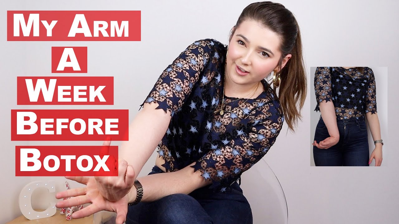 My Arm A Week Before I Have Botox Injections. - YouTube