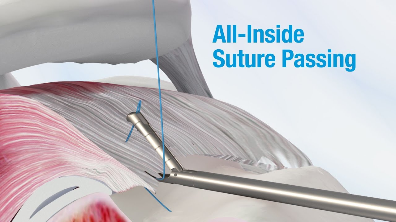 Spectrum® AutoPass™ Suture Passer - CONMED Product Video - YouTube