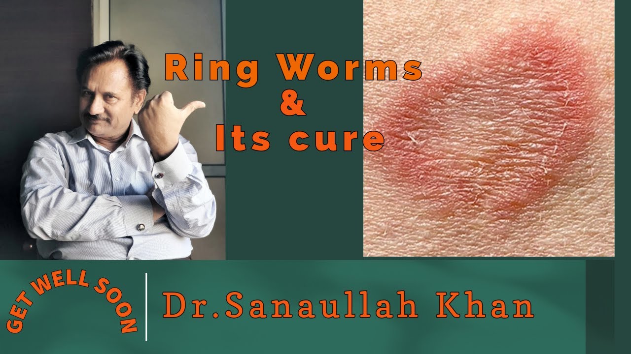 RINGWORMS And Its Cure - YouTube