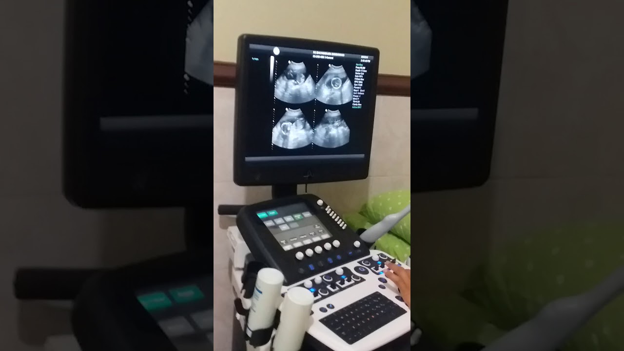 Hasil USG bayi umur 5 bulan dalam kandungan yang sehat - YouTube