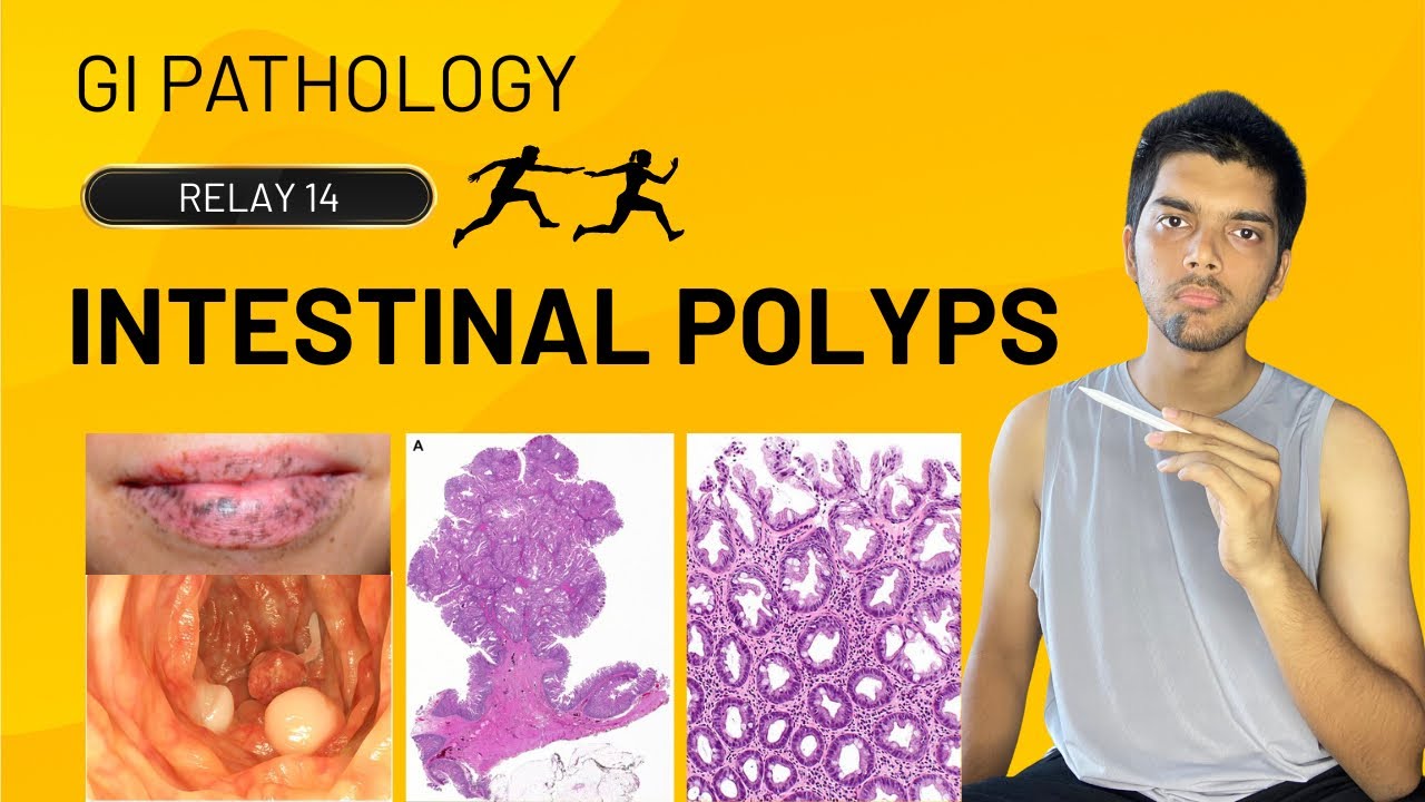 INTESTINAL POLYPS - GI Pathology 14 - Intestine - Complete Systemic ...