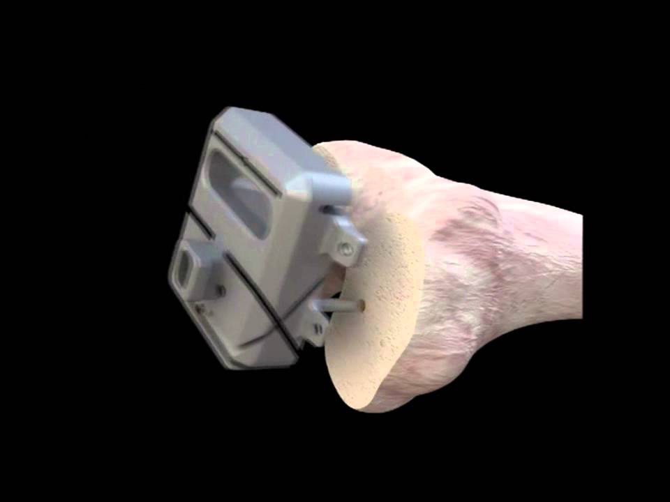 Customized Knee Replacement Animation - YouTube