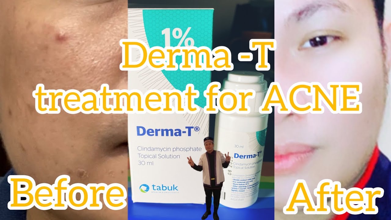 Derma T solution for ACNE - YouTube